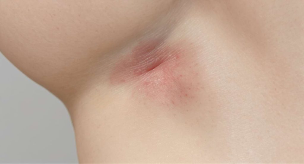 Ganglion sous l’aisselle : ce qu’il faut savoir 🦠🤔